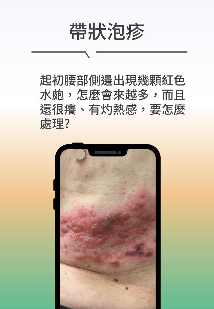 帶狀疱疹「皮蛇纏身」怎麼治療 疱疹後神經痛該如何緩解